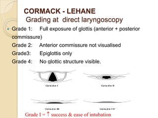 Airway assessment | PPTX