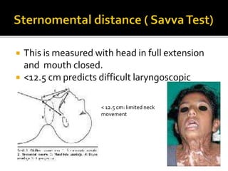 Sternomental Distance