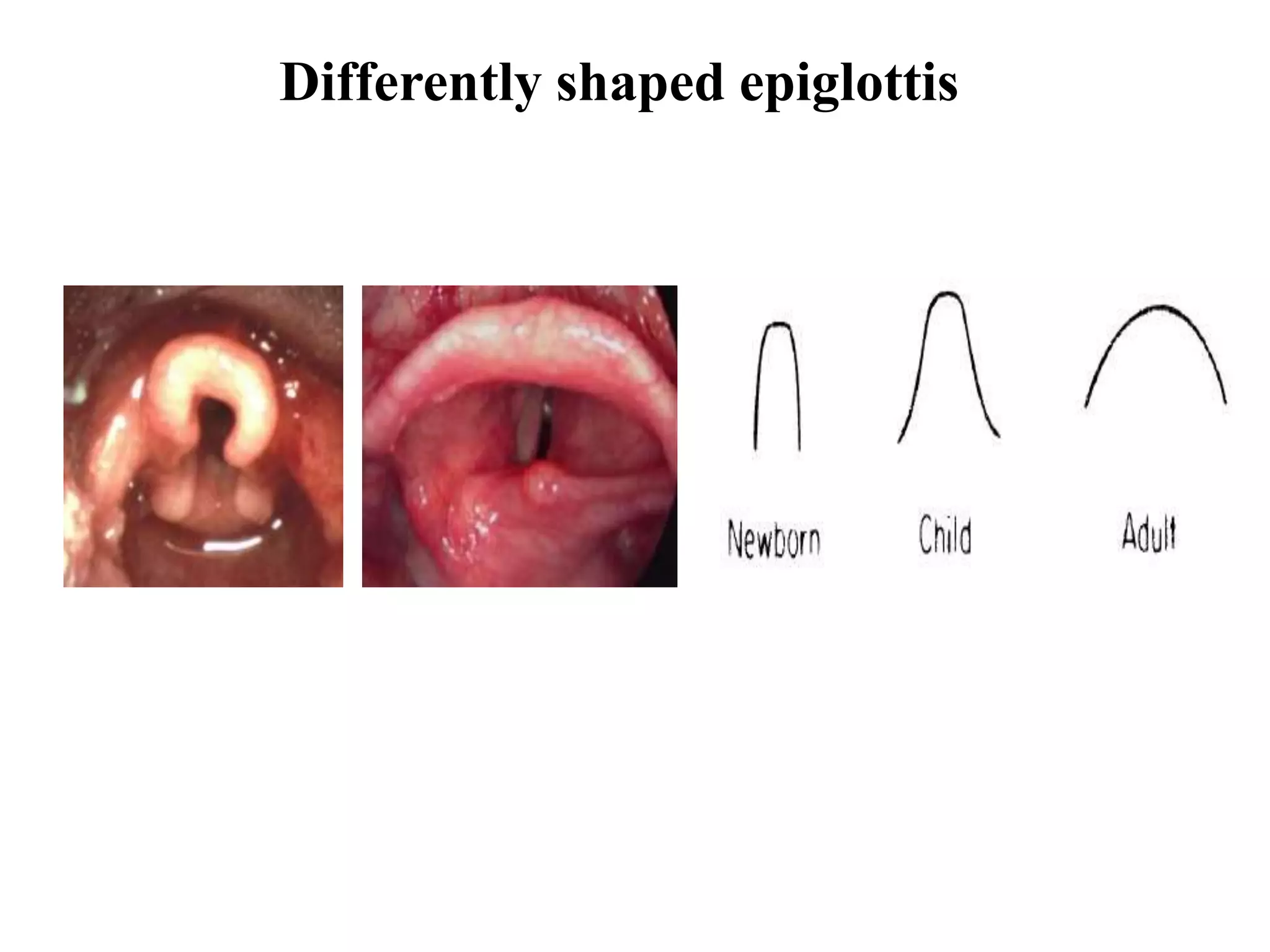 AIRWAY ASSESSMENT IN PAEDIATRICS PATIENTS-LARYNGOSCOPY, INTUBATION | PPTX