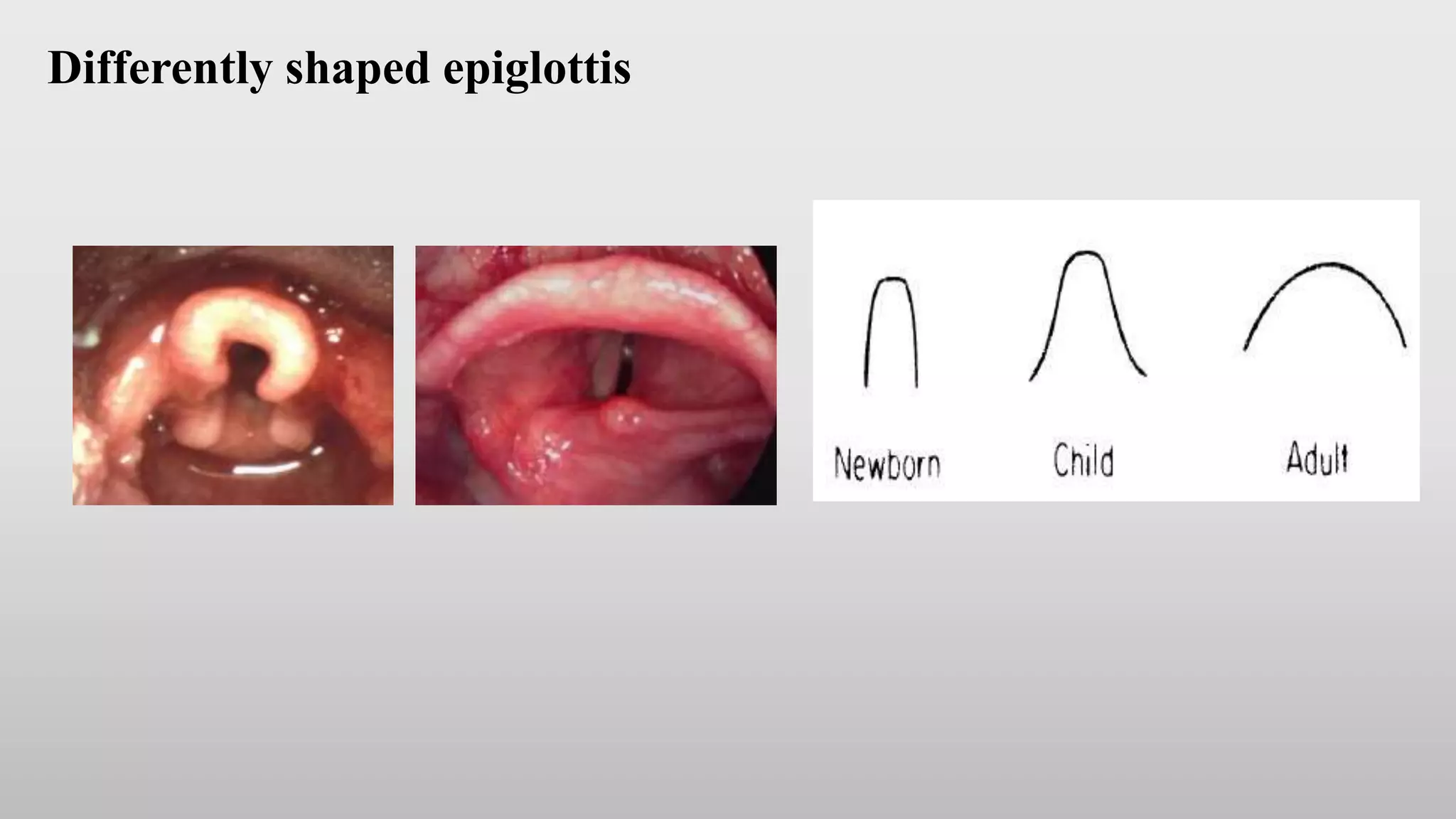 Airway assessment between adult & paediatrics | PPTX
