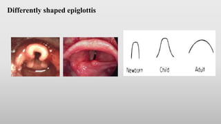 Airway assessment between adult & paediatrics | PPTX