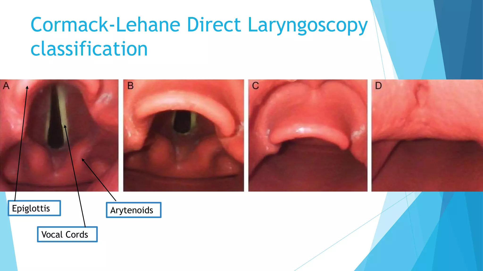 Airway assessment in anaesthesia | PPTX