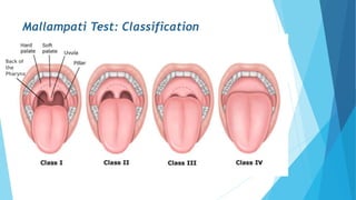 Airway assessment in anaesthesia | PPTX