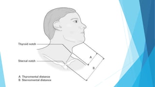 Airway assessment in anaesthesia | PPTX