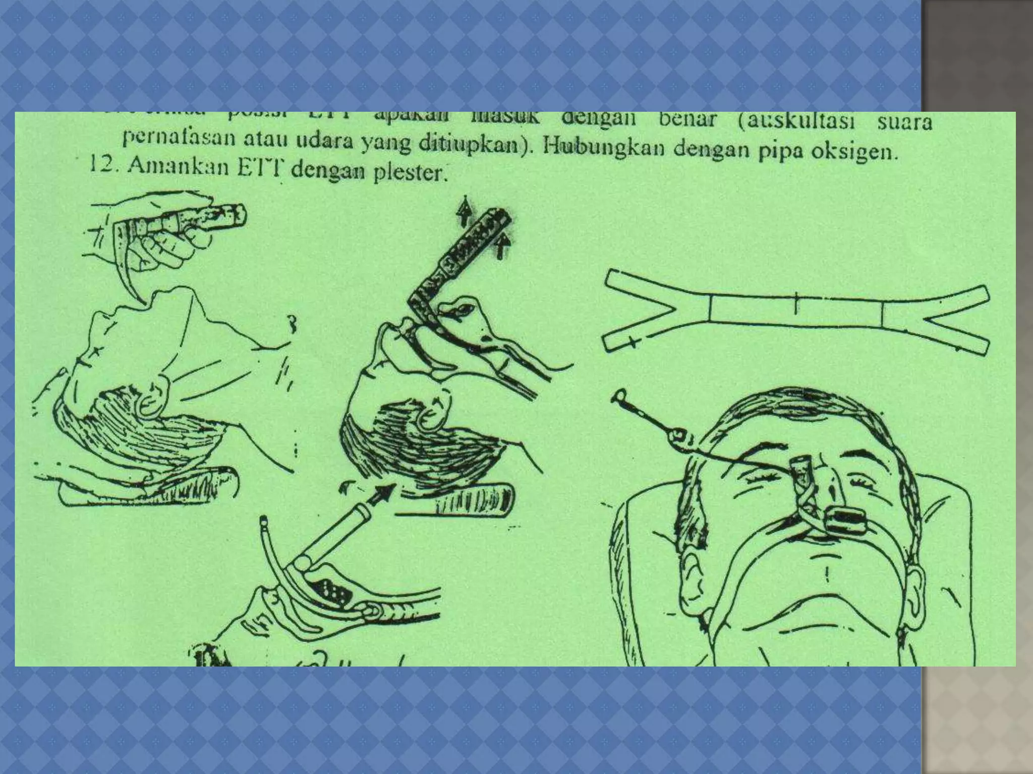Airway, Breathing dan Circulation (ABC) | PPTX