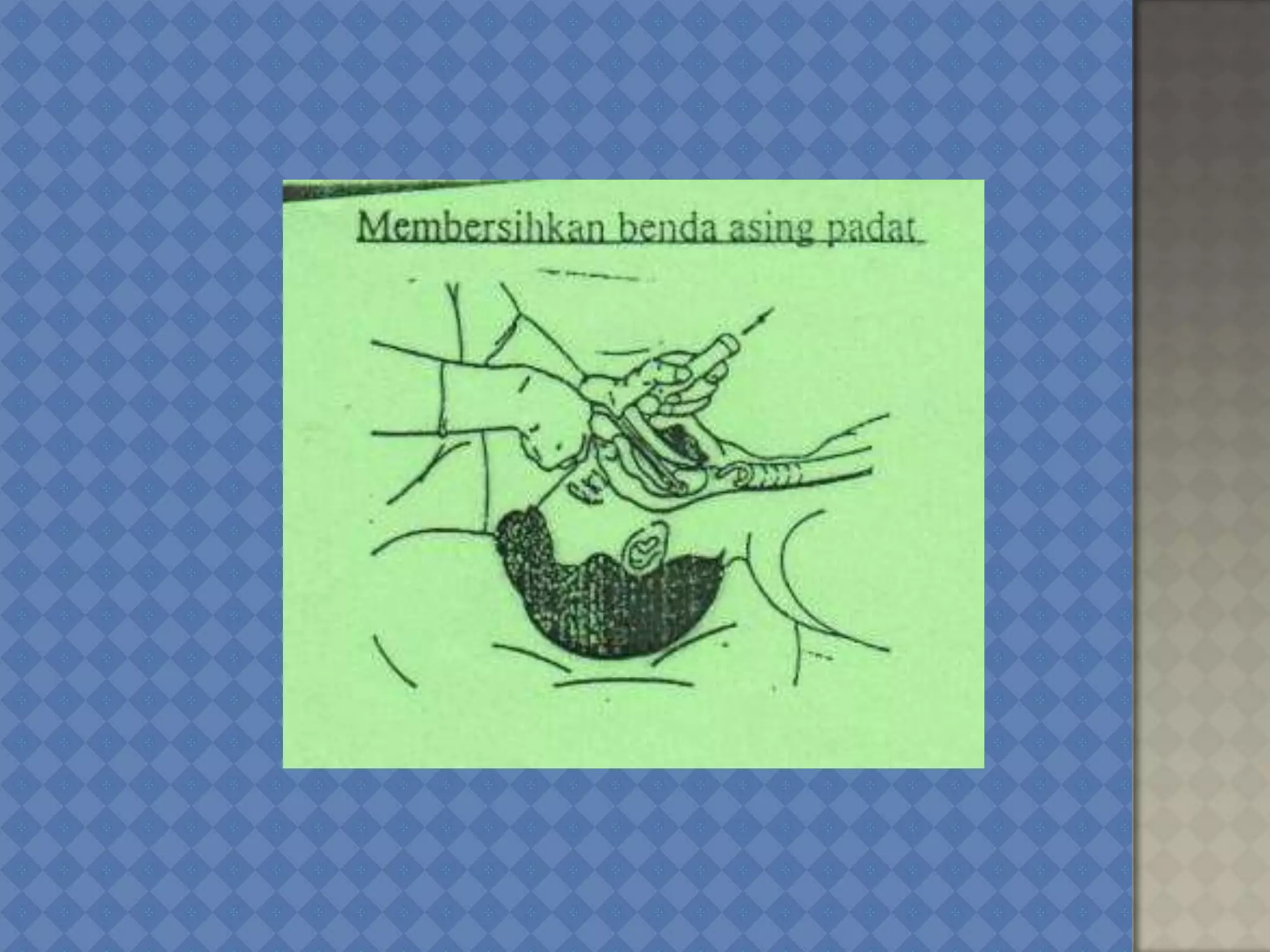Airway, Breathing dan Circulation (ABC) | PPTX