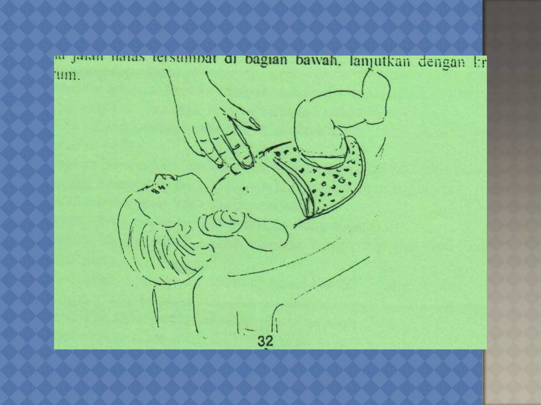Airway, Breathing dan Circulation (ABC) | PPTX