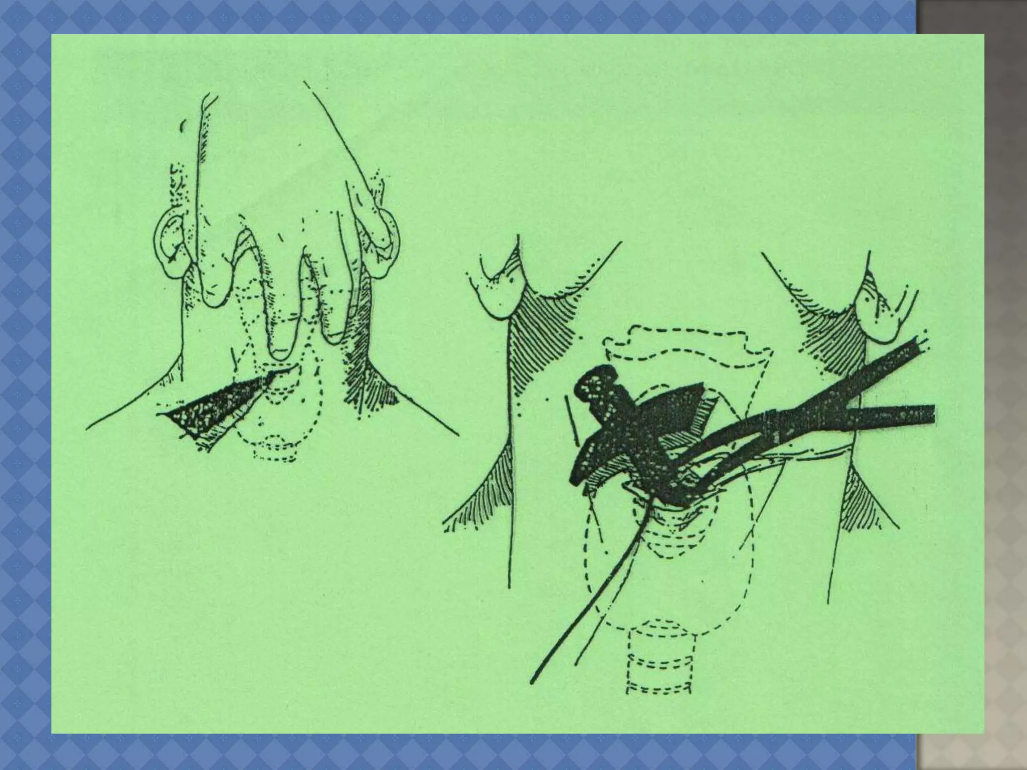 Airway, Breathing dan Circulation (ABC) | PPTX