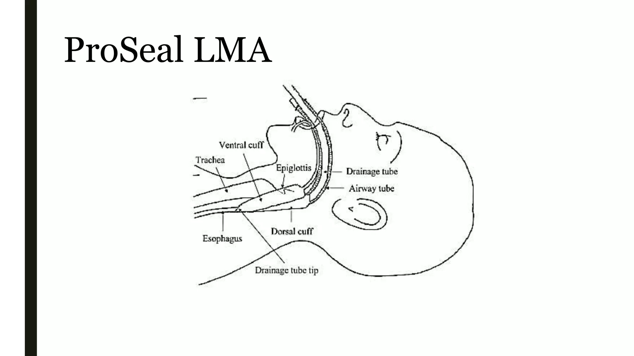 Airway devices and adjuncts | PPTX