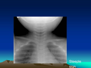 Air way emergencies.ppt