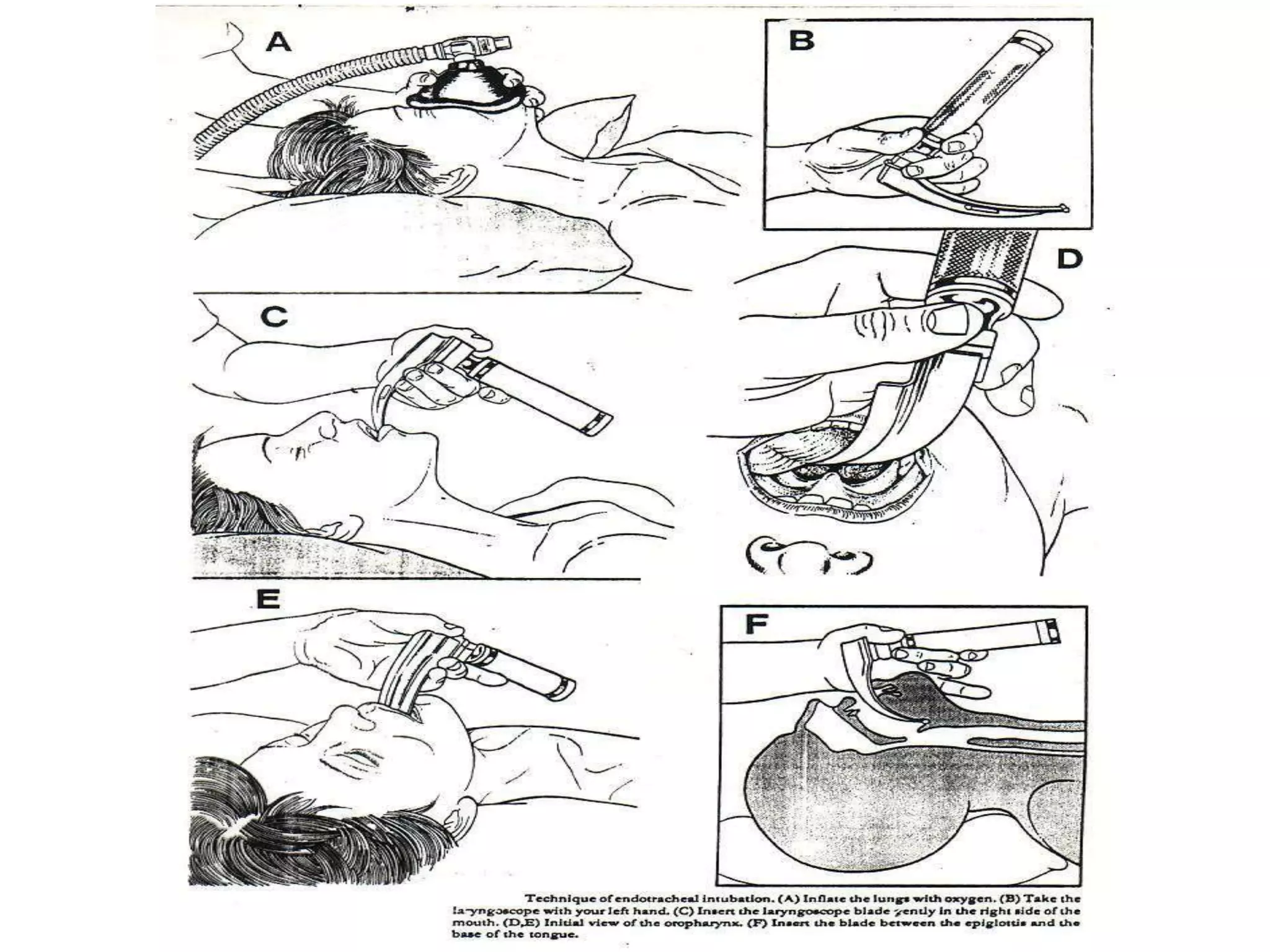 AIRWAY FIX.pptx