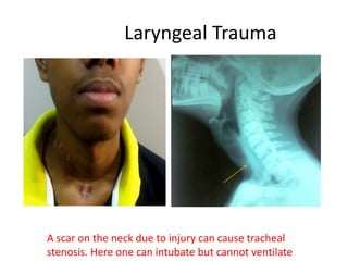 Airway inubation difficulties | PPTX