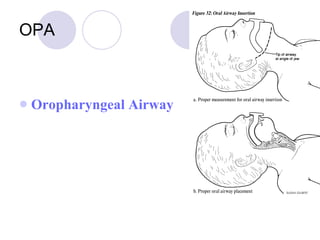 Airway Management | PPT