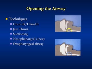 Airway management | PPT