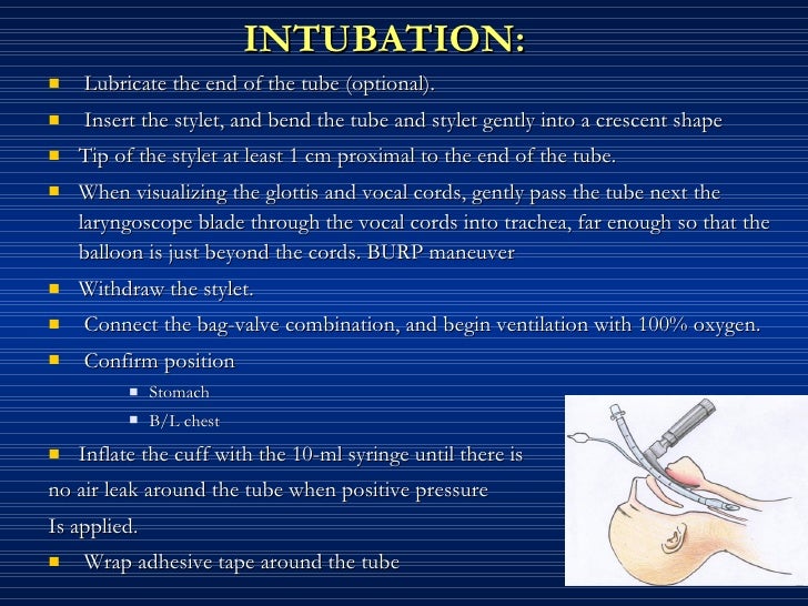 Airway management