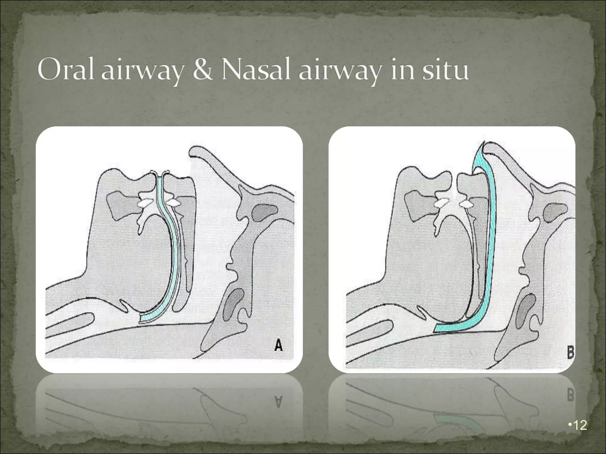 Airway management | PPT