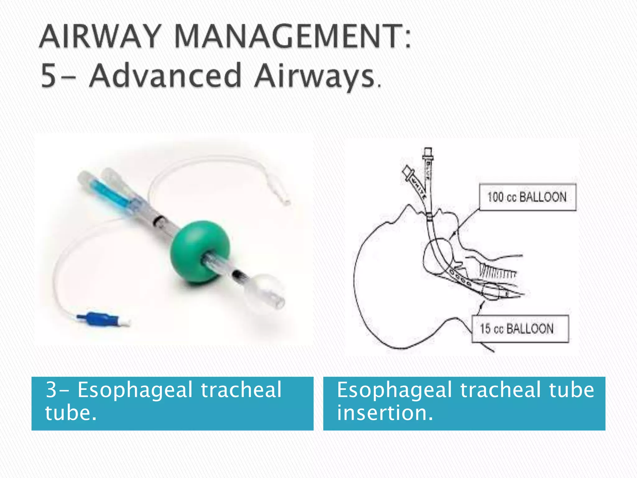 Airway management | PPTX