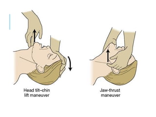 Airway Management | PPT