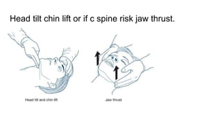Airway management | PPT