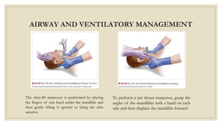 AIRWAY MANAGEMENT on trauma head and thorax case.pptx
