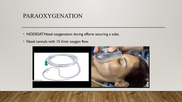 AIRWAY MANAGEMENT.pptx In ent ,tracheostomy | PPT