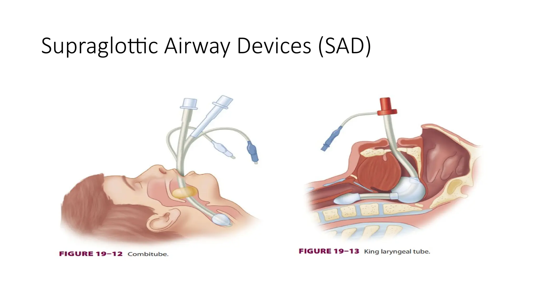 AIRWAY ANATOMY, DIFFICULT INTUBATION, Supraglotic airway devices, Video ...