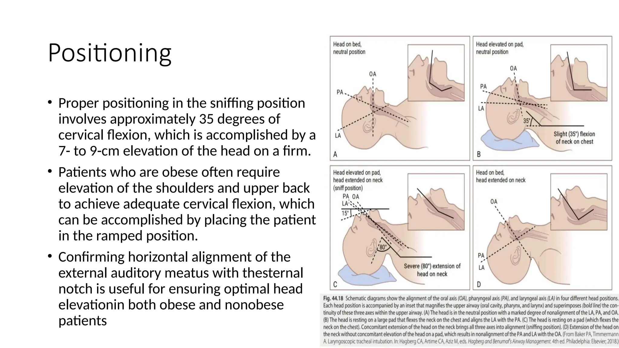 AIRWAY ANATOMY, DIFFICULT INTUBATION, Supraglotic airway devices, Video ...