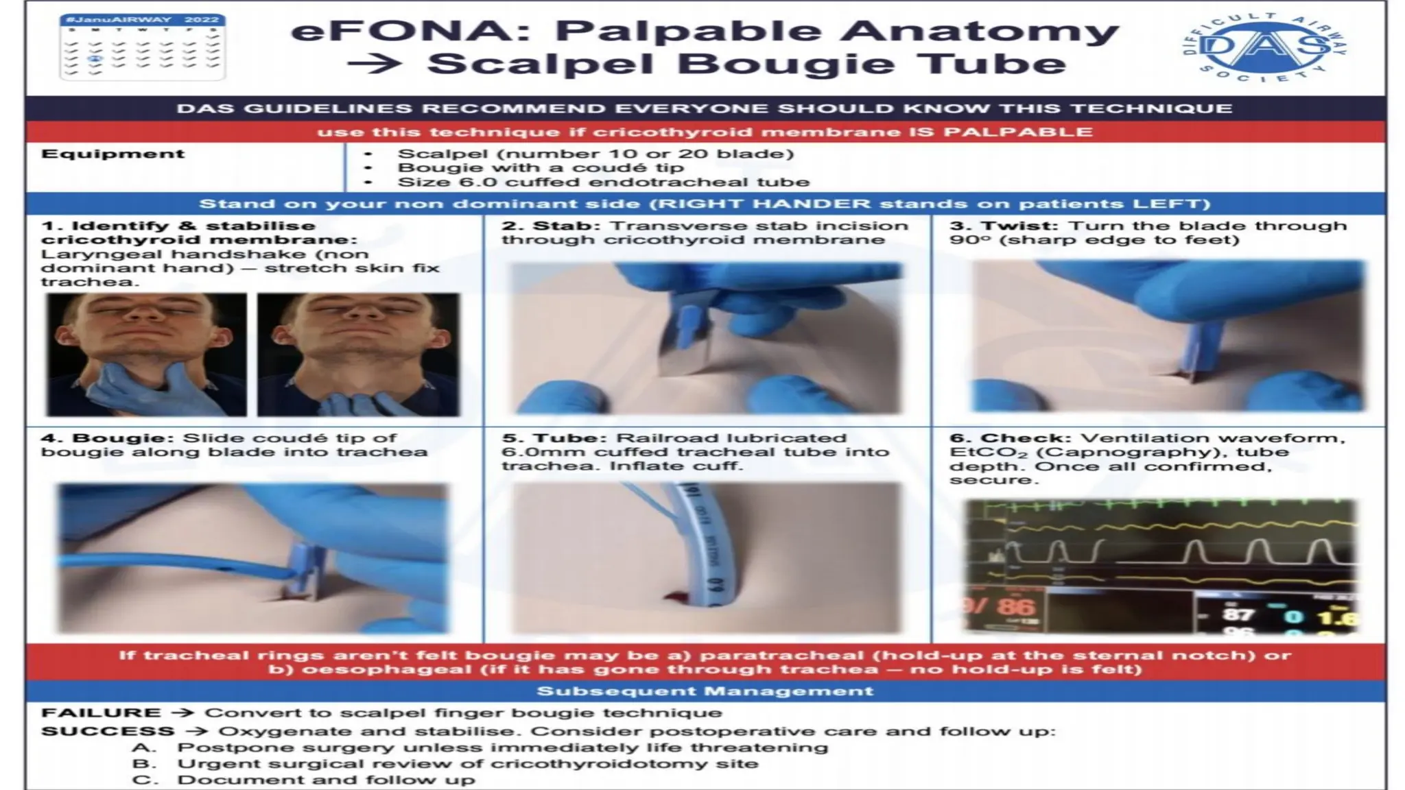 AIRWAY ANATOMY, DIFFICULT INTUBATION, Supraglotic airway devices, Video ...