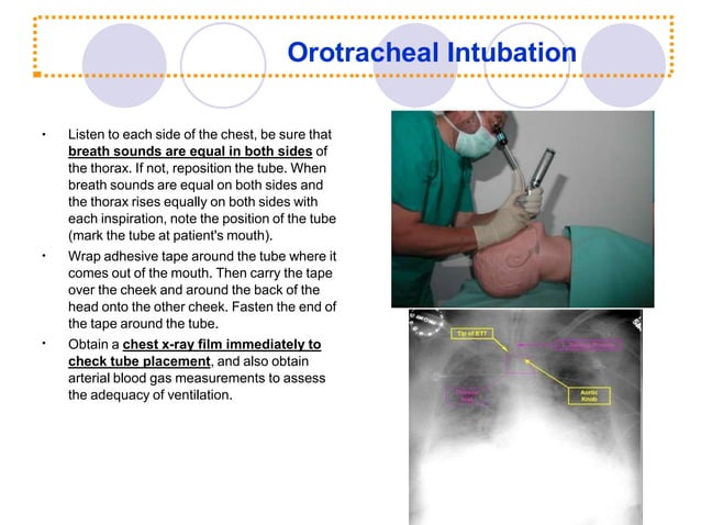 AIRWAY MANAGEMENT-INTUBATION (2).ppt | Ear, Nose and Throat Conditions ...