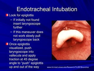 Airway management | PPT