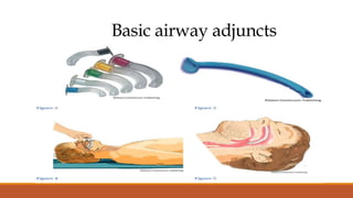 Airway Management and Intubation.pptx