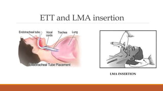 Airway Management and Intubation.pptx