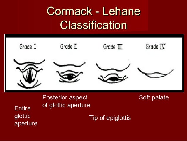 Airway management for lu6