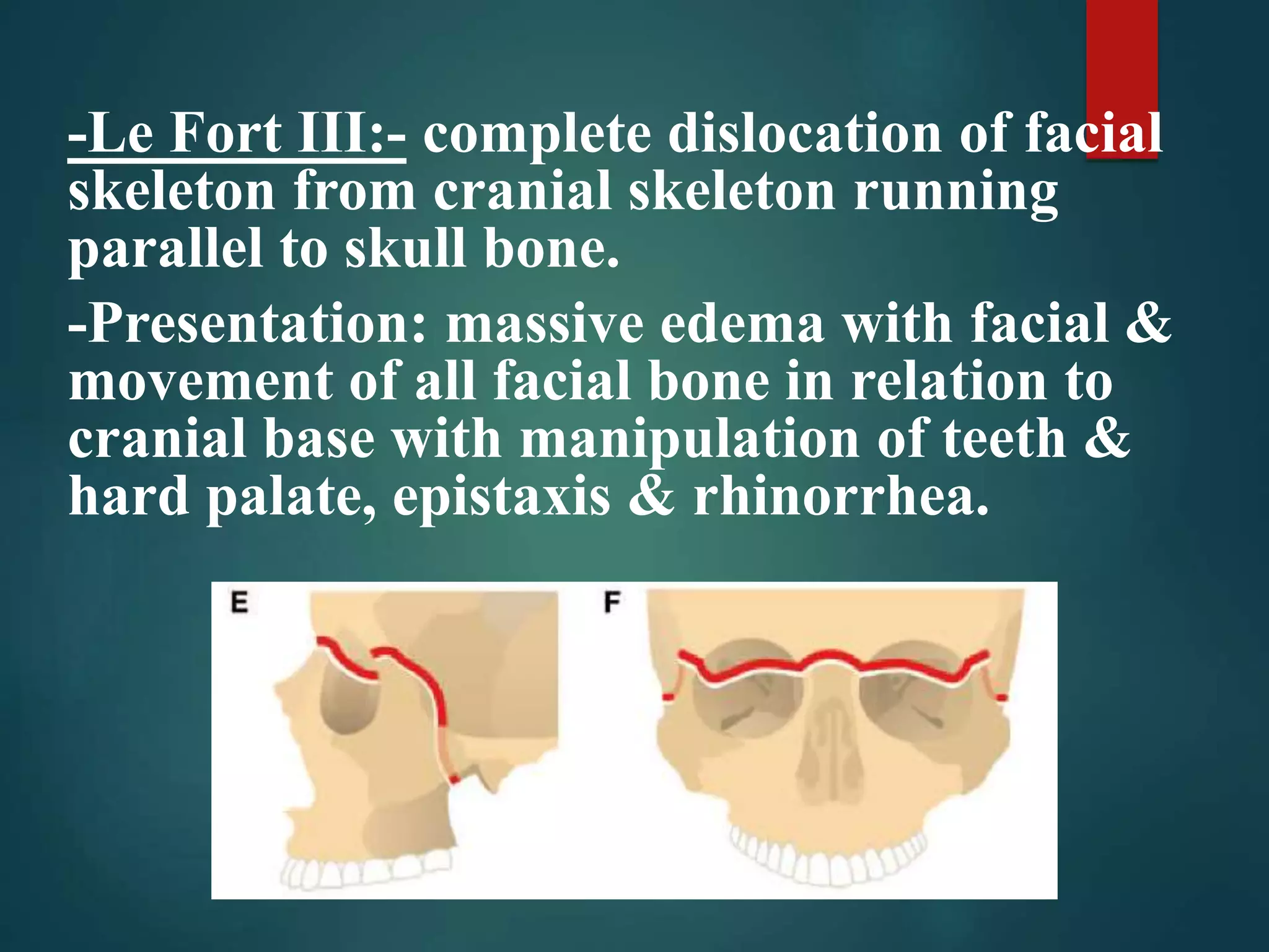Airway management in maxillofacial trauma | PPTX