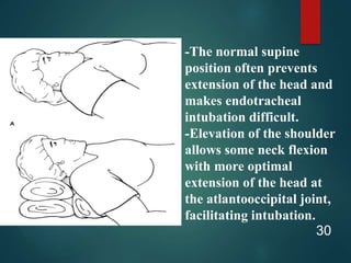 Airway management in obstetrics patient | PPTX