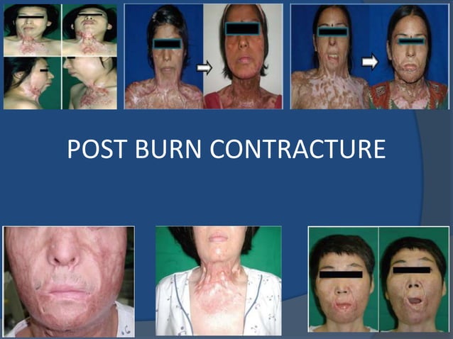 Airway management in post burn contracture & TMJ | PPTX | First Aid ...