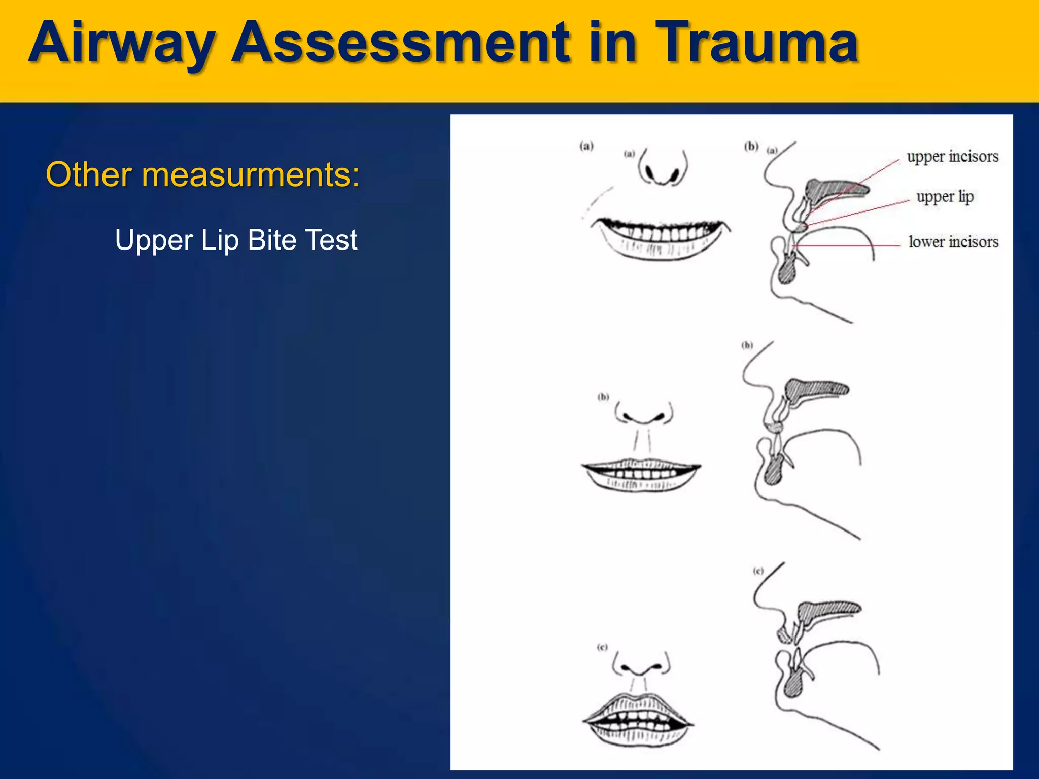 Airway management in trauma patients | PPTX