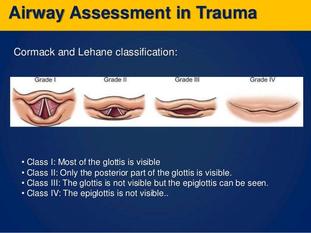 Airway management in trauma patients