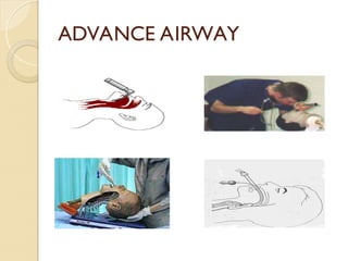 AIRWAY MANAGEMENT adult FOR RAPID ICU.ppt