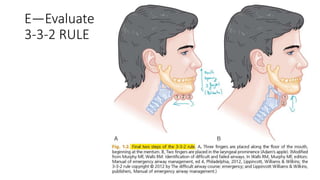 Airway management techniques by Dr Than Vutha | PPT