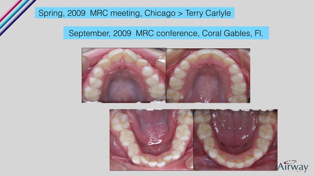 Airway Mini-residency: Intro to Airway Orthodontics | PDF | Ear, Nose ...