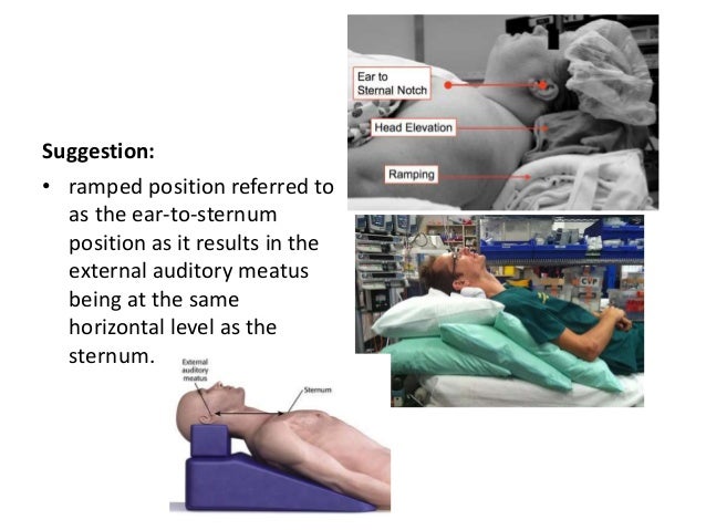 Airway mx of critically ill pt updated 2016