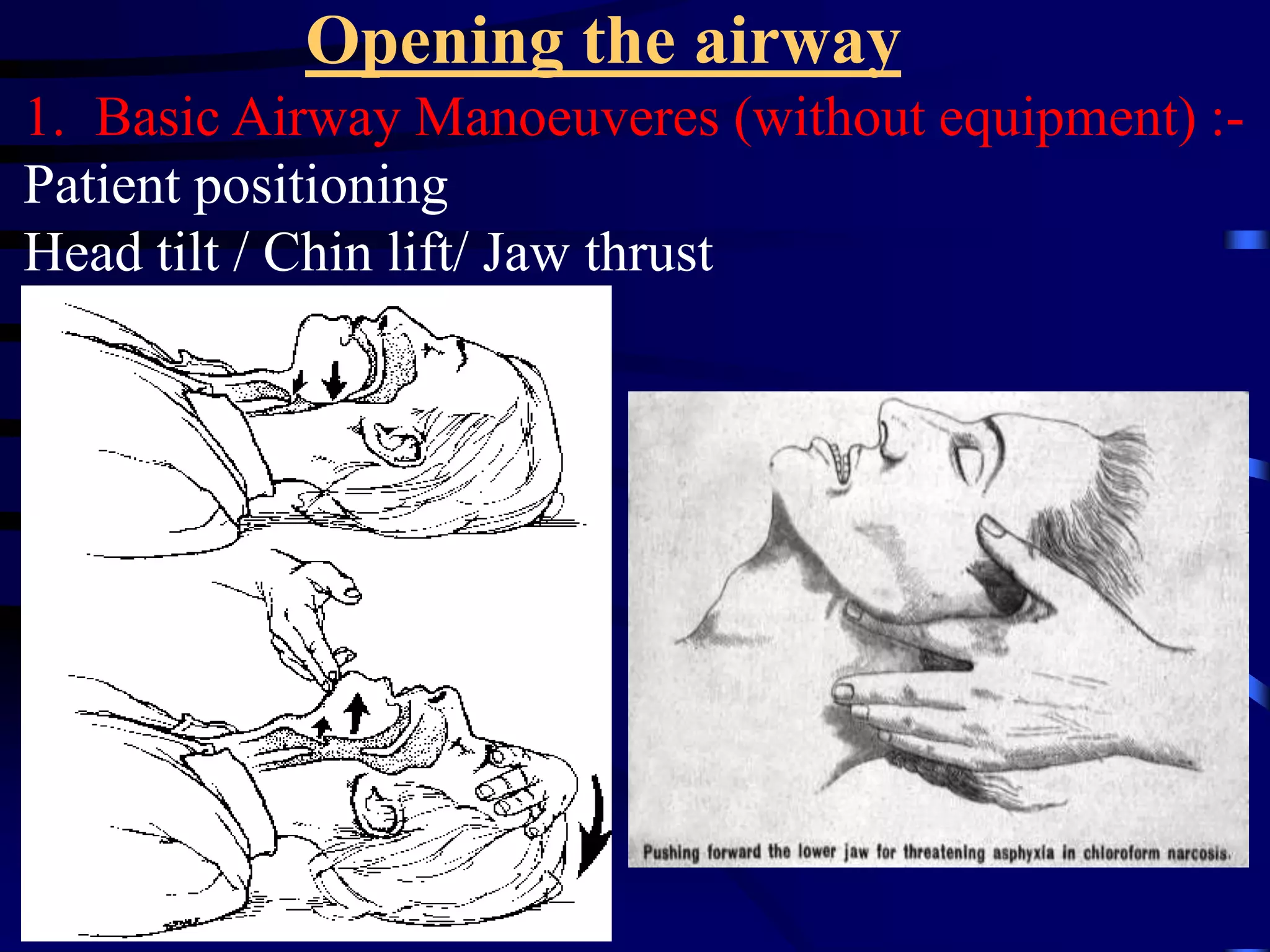 Airway management | PPTX
