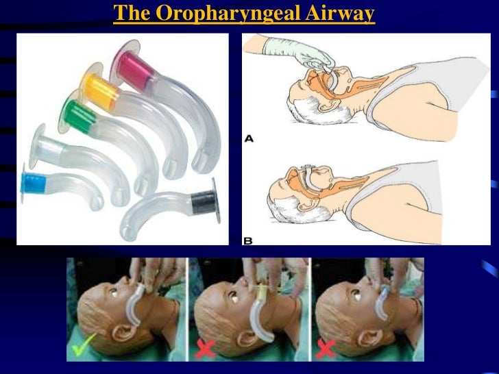 What Is Airway Protection at Sylvia Partington blog