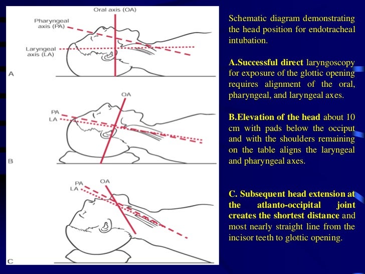 Airway management