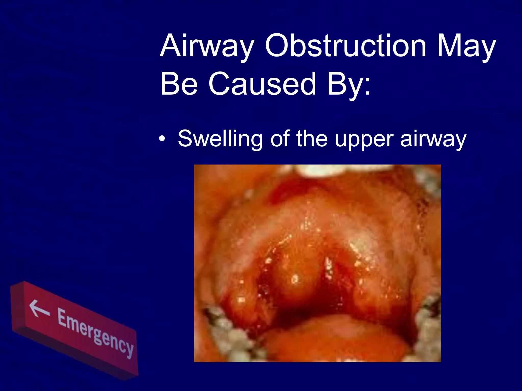 Airway obstruction1 | PDF