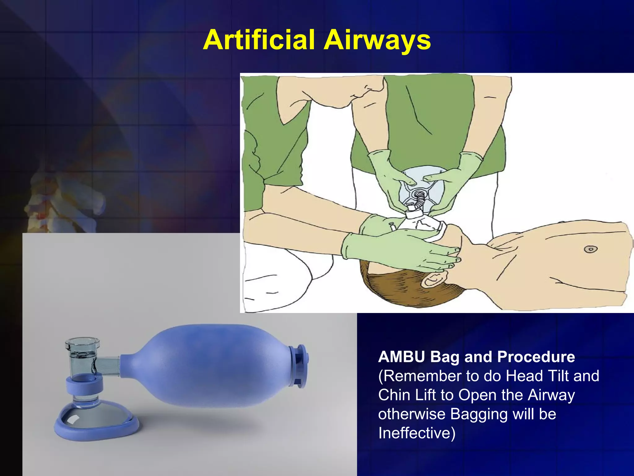 Airway obstruction and management | PPT