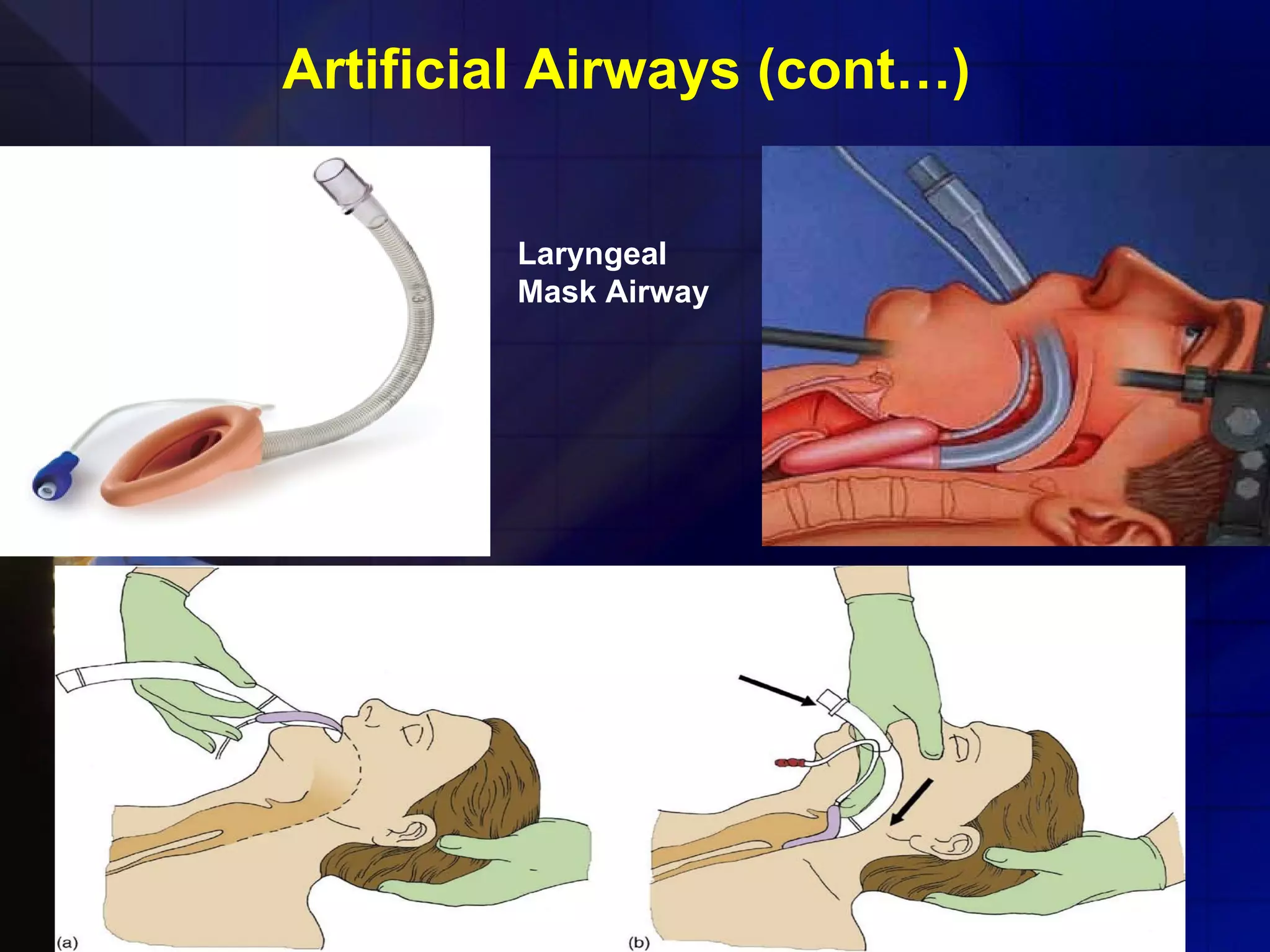 Airway obstruction and management | PPT