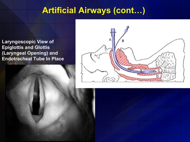Airway obstruction and management | PPT