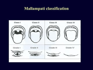 Airway Management | PPT